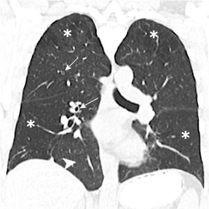 Imaging in COPDGene – COPD Gene Study