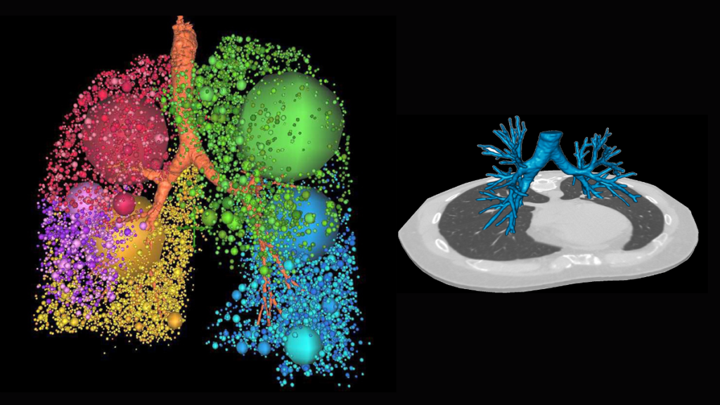 Copd Gene Study The Copdgene Study Investigates The Underlying